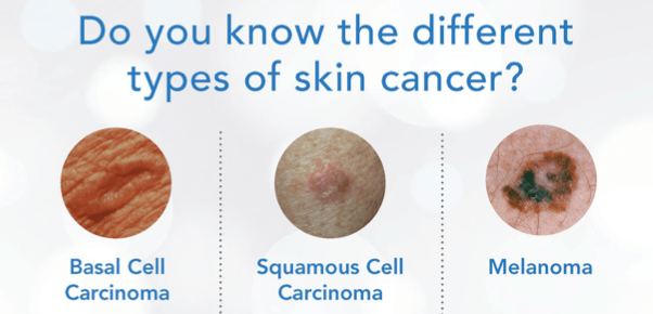 Types Of Skin Cancer How To Recognize The Different Types Of Skin