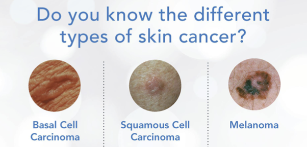 Skin Cancer New Course: Skin Cancer – Early Diagnosis GatewayC